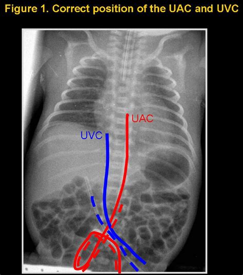 Figure 1 From Umbilical Catheters Location And Complications