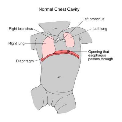 There Are Two Types Of Diaphragmatic Hernia