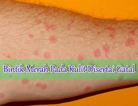 Obat Gatal Bintik Merah Menyebar Paling Ampuh Di Apotik LOVESEAT