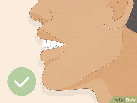 How To Cure Overbite Proofcheek Spmsoalan