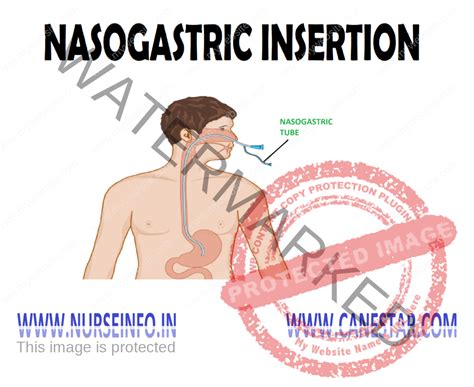 NASOGASTRIC INSERTION Nurse Info