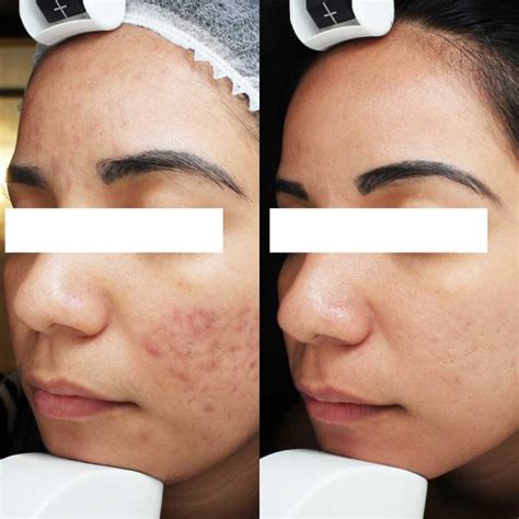 Tratamiento de Acné Activo con Láser IPL Clínica Chávarri