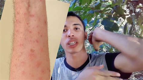 SINTOMAS ESCABIOSE SARNA HUMANA YouTube
