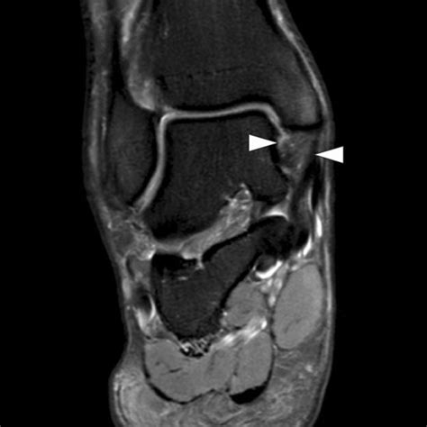 Deltoid Ligament Ultrasound