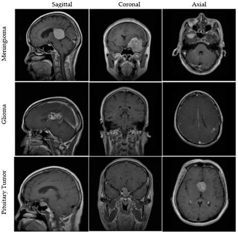 What Size Brain Tumor Is Considered Large Mri Tumor Classification