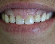 Prótese Dentária de Silicone Fixa Cultura Mix