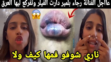 صااادم الفنانة رجاء بلمير دارت الفيلر وتفرݣع ليها العرق نااري شوفو فمها كيف ولا كنخاف من زواج