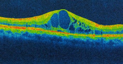 Retinal Swelling After Cataract Surgery Eye Surgery Guide