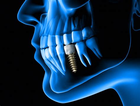 Consigue Una Sonrisa Sana Y Linda Con Los Implantes Dentales De Carga