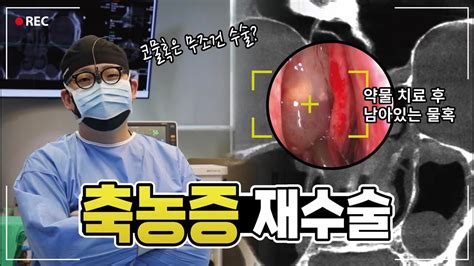 축농증 재수술 코리아 이비인후과 revision ESS endoscopic sinus surgery YouTube
