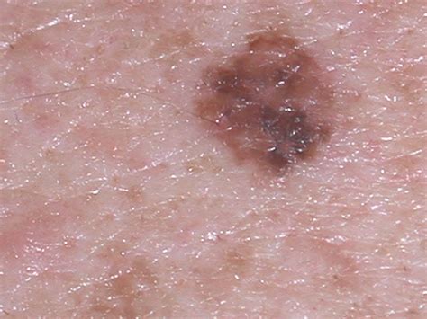Malignant Melanoma Stage