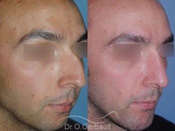Photos de profiloplastie avec avancée du menton avant et après