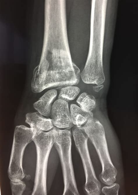 Fracture Du Poignet Institut De La Main Medipole Toulouse