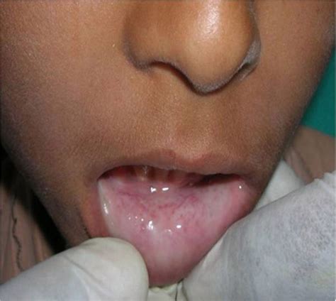 Oral Submucous Fibrosis Blanching