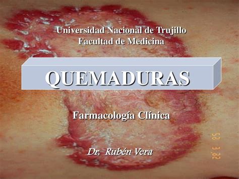 Quemaduras MARYURI LISBETH UDocz