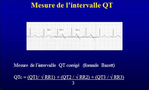 Diagnostic Bilan Prise Charge Et Surveillance Du Syndrome Du QT Long