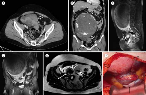 A 60 Year Old Female With Torsion Of Myomatous Uterus A Axial And