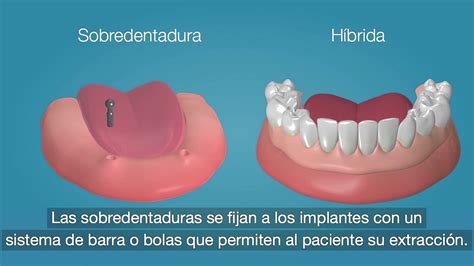 Prótesis Híbrida Vs Sobredentadura Clínica Dental MiBO Almería YouTube