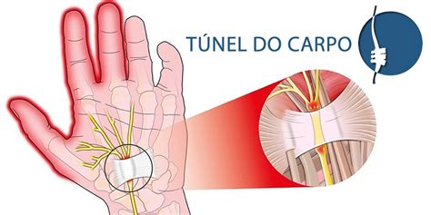 Síndrome do túnel do carpo uma dor que pode ser tratável Clínica da
