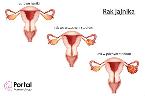 Rak Jajnika Portal Kosmetologa