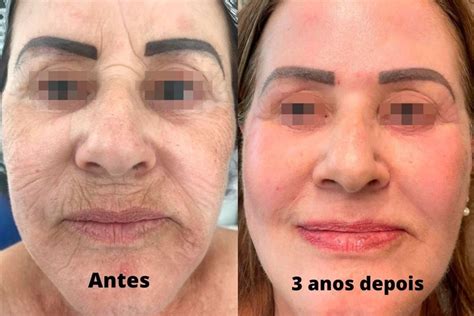 Peeling De Fenol Vale A Pena O Sofrimento Experts Explicam A T Cnica