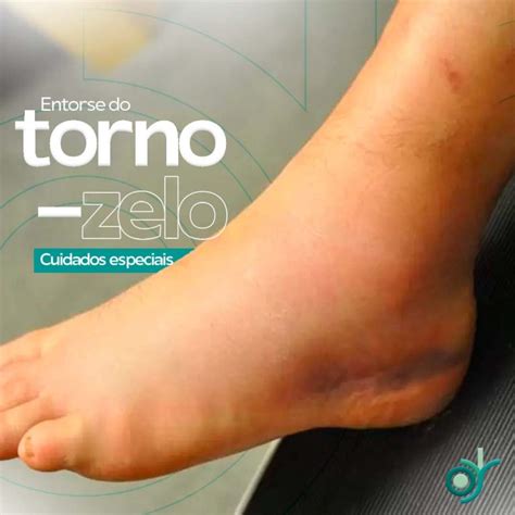 Entorse Do Tornozelo Ortotrauma
