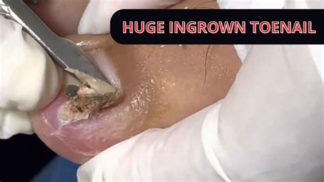 Huge Ingrown Toenail Ingrown Toenail Ingrown Toenail Removal YouTube