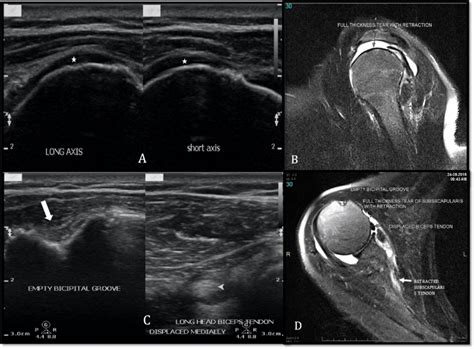 Complete Rotator Cuff Tear With Medially Displaced Long Head Of Biceps