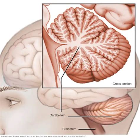 Ataxia qué es cuáles son sus síntomas centro activa