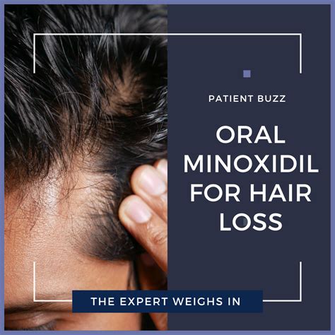 Top 48 Image Minoxidil Oral For Hair Loss Thptnganamst Edu Vn