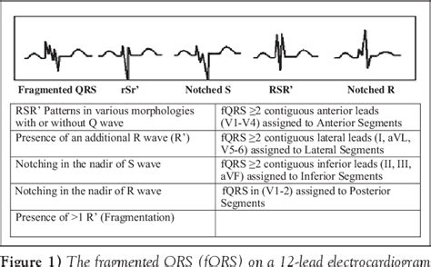 figure 1 from the utility of fragmented qrs complexes to predict significant intraventricular