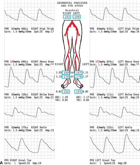 Lower Extremity Arterial Ultrasound Criteria