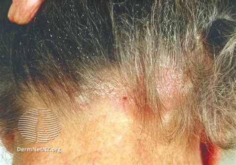 Scalp Eczema Symptoms Causes And Treatments Myeczemateam