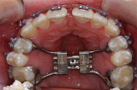 Crowding Teeth