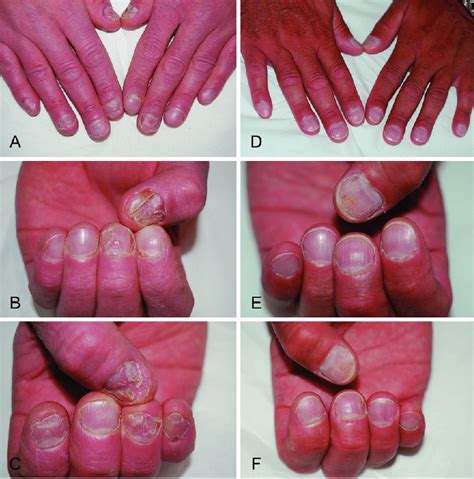 Clinical Manifestation Of Nail Psoriasis With Crumbling And Download Scientific Diagram