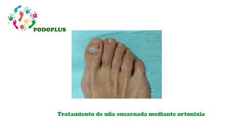 Tratamiento de uña encarnada del pie mediante ortonixia YouTube