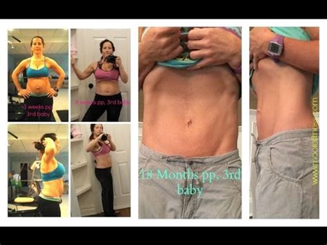 Your Guide To Treating Diastasis Recti PART 1 YouTube