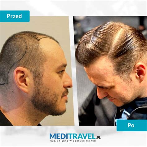 Przeszczep W Os W Artas Przeszczep W Os W W Turcji Meditravel Pl