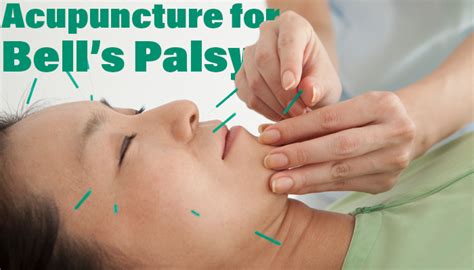 Acupuncture For Bell S Palsy Chiro Acupuncture Elgin