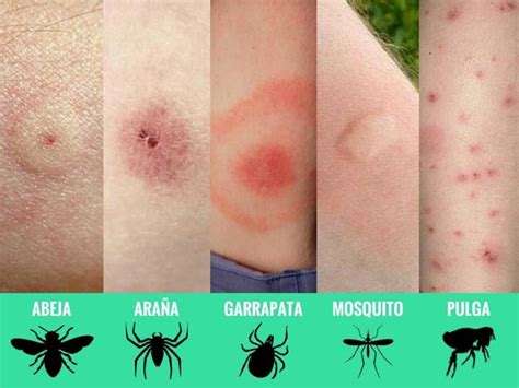 Las picaduras de mosquito y su reacción alérgica Atres Policlínica