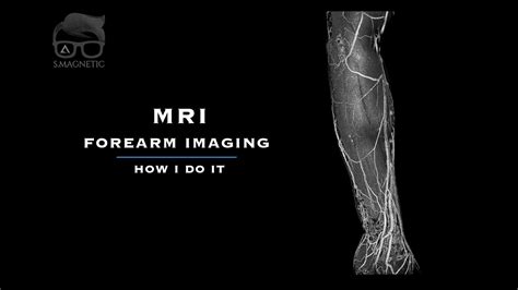 MRI FOREARM IMAGING How I Do It YouTube