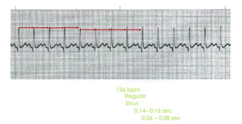 Ekg Rhythm Strips Flashcards Quizlet