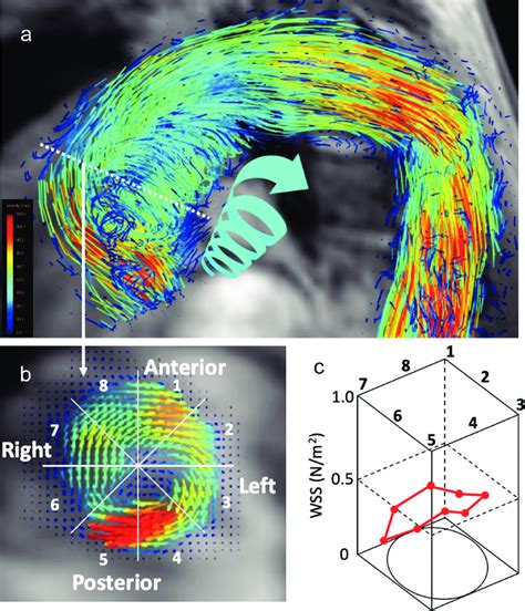 Flow Patterns And Wss Estimation In A Bicuspid Aortic Valve Patient