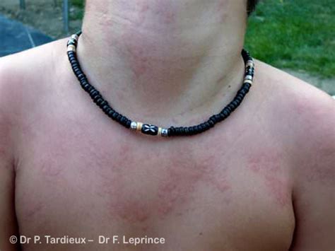 Urticaire Asthme Et Allergies Et Urticaire