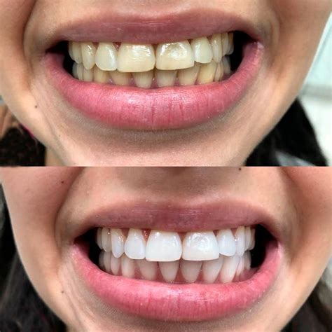 Clareamento Dental Só Sorriso Odontologia Recreio do Bandeirantes