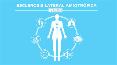 esclerosis lateral amiotrófica Nepsa Rehabilitación Neurológica