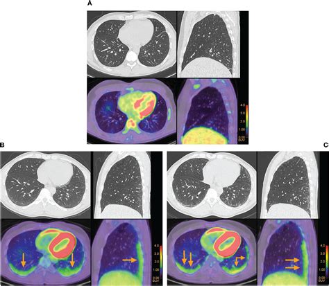 Frontiers Positron Emission Tomography To Improve Assessment Of