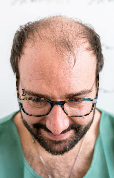 Greffe de cheveux quel résultat après 1 mois