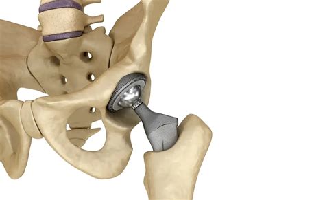 Artroplastia de quadril o que é e como é feita Grupo Articulação