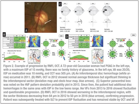 monitoring glaucoma progression with oct